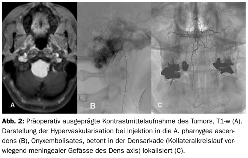 Preoperative onyx embolization followed by endoscopically assisted ...