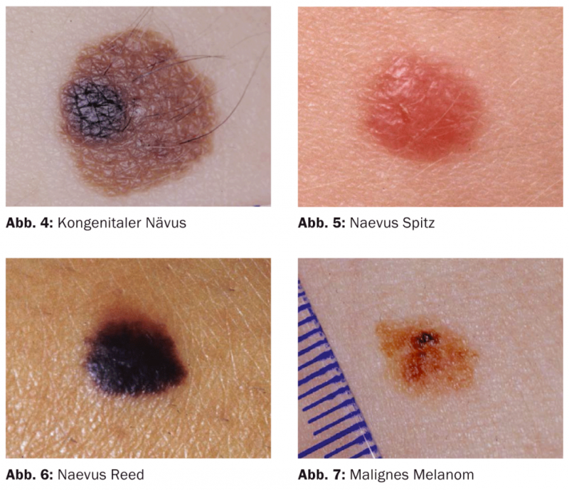 Nevus melanocíticos y melanoma maligno - Medizinonline