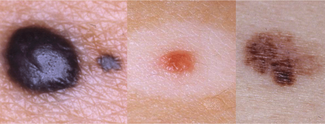 Nevus melanocíticos y melanoma maligno - Medizinonline