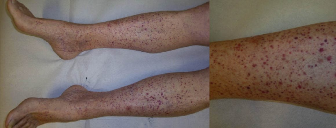Cutaneous Vasculitis - Overview for Practice - Medizinonline