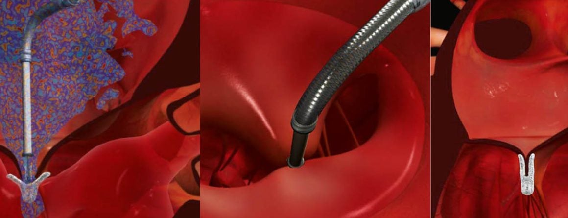 MitraClip, annuloplastie mitrale et remplacement valvulaire - Medizinonline