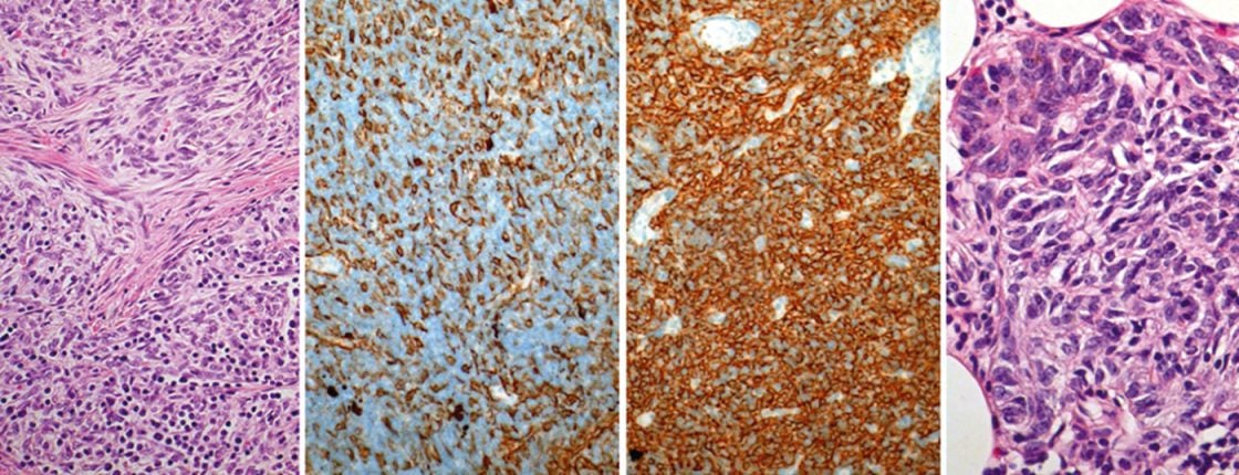 Tumores tímicos - diagnóstico y terapia - Medizinonline