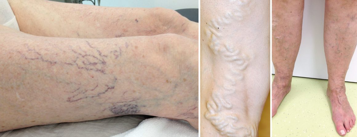 Varizentherapie – mit Schaum, Licht oder Stahl? - Medizinonline