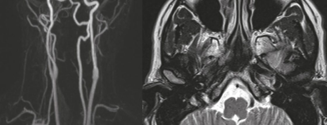 Rare case of vertebral dissection while playing tennis - Medizinonline