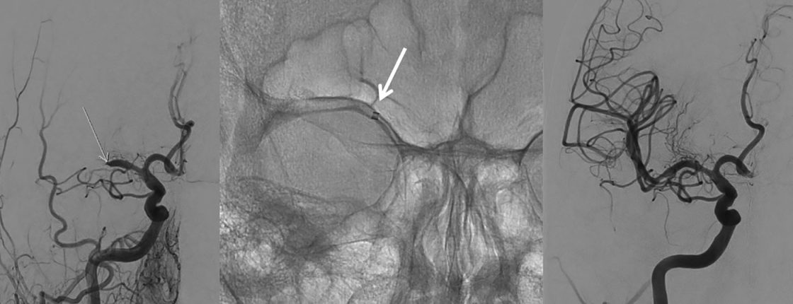 Rapid mechanical recanalization for occlusion of large cerebral ...