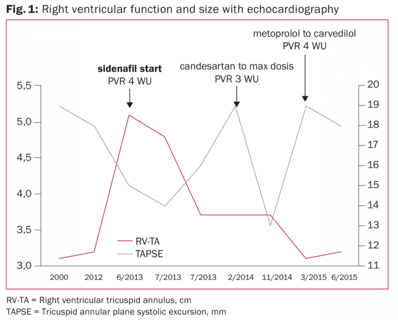 An important sign of advanced heart failure - Medizinonline