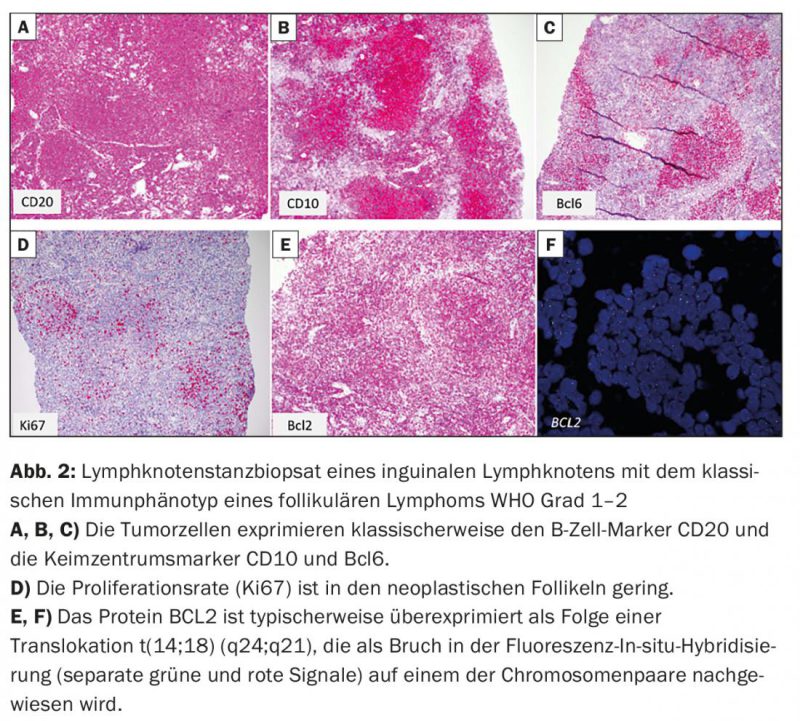 Diagnosis and treatment options for "indolent" non-Hodgkin's lymphoma ...
