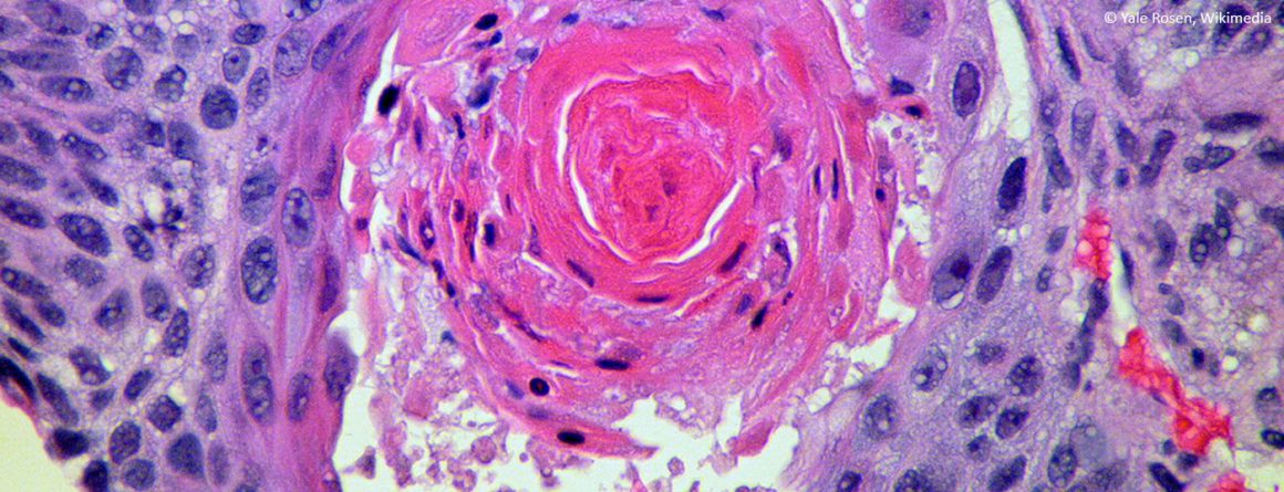 Terapia sistémica actual en el cáncer de pulmón no microcítico ...
