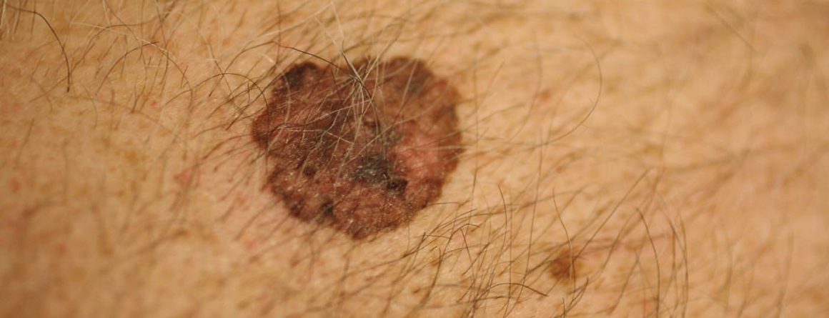 Melanoma maligno, terapia dirigida e inmunoterapia - El camino hacia el ...