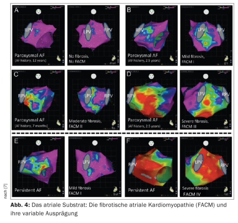 Catheter ablation of atrial fibrillation: a pathophysiology-based ...