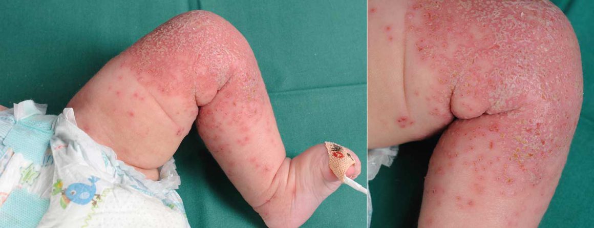 Exantemas víricos seleccionados en la infancia - Medizinonline