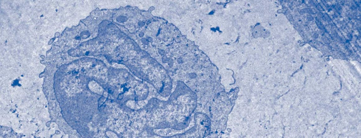 The Sézary syndrome - Medizinonline