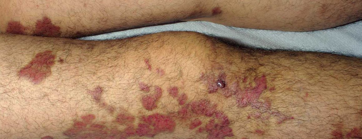 Cutaneous disorders in immunosuppressed HIV infected patients and their ...