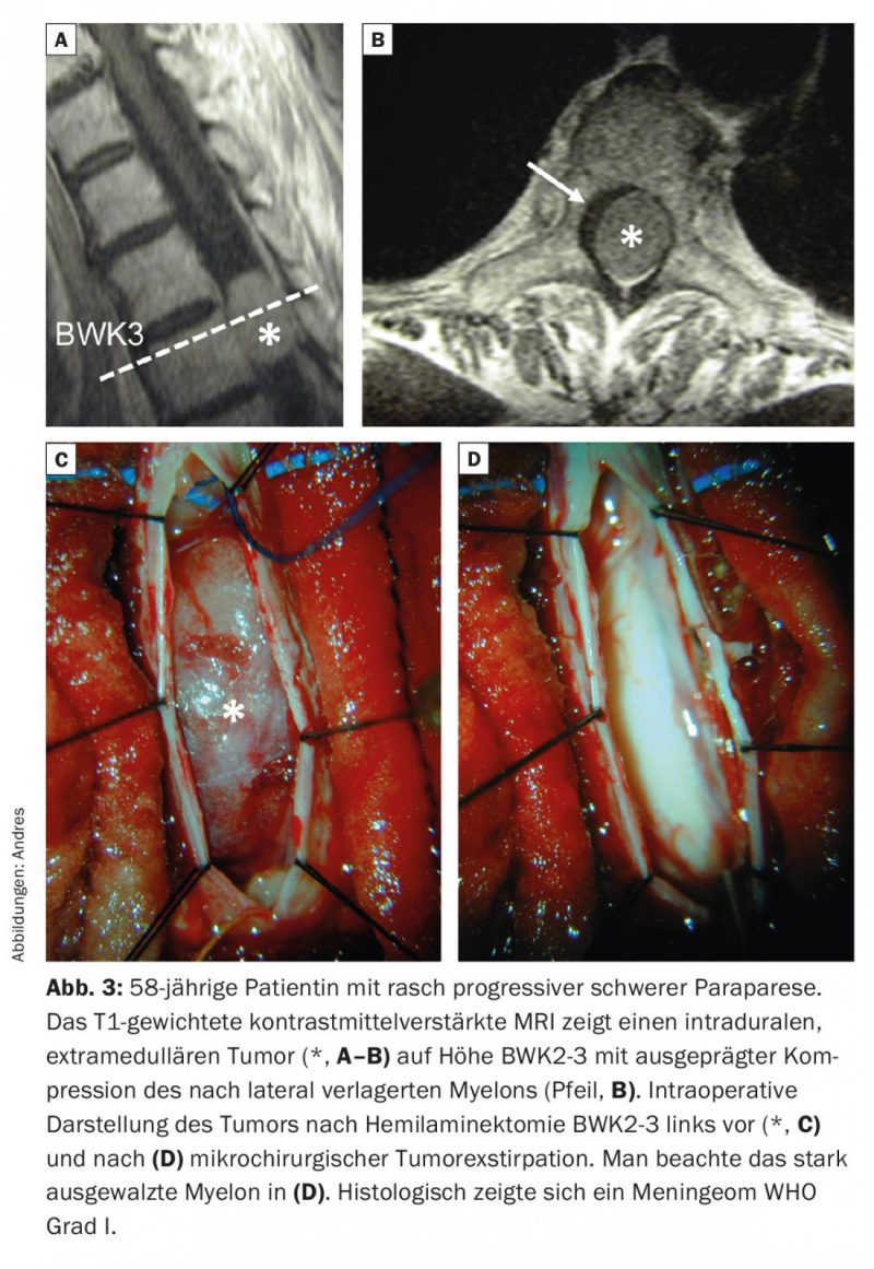 Surgical treatment options for paraplegia. - Medizinonline