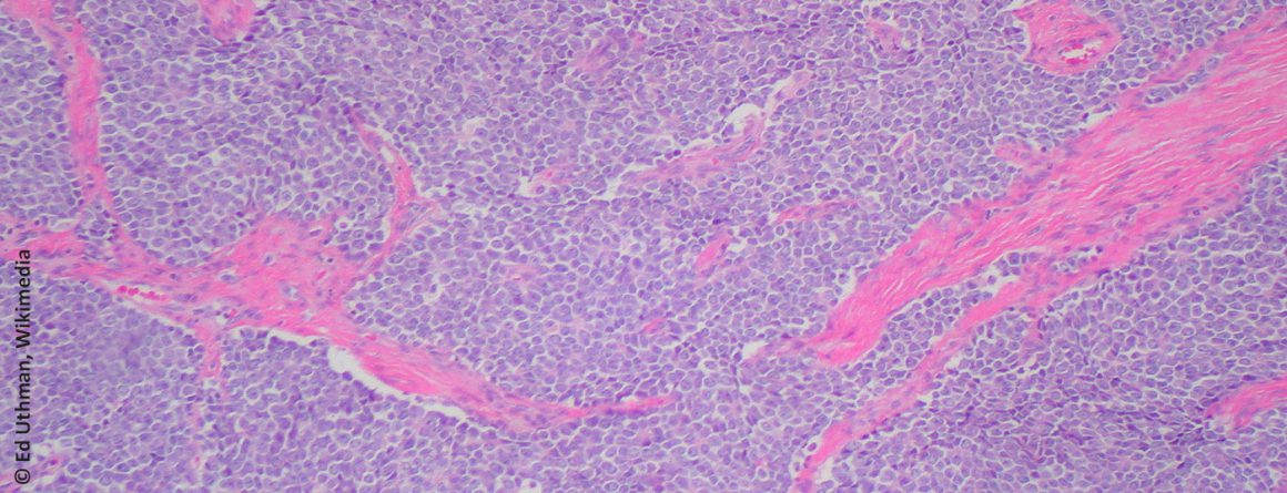 Management of the second most common primary malignant bone tumor ...