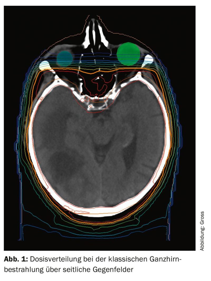Radioterapia de las metástasis cerebrales - Medizinonline