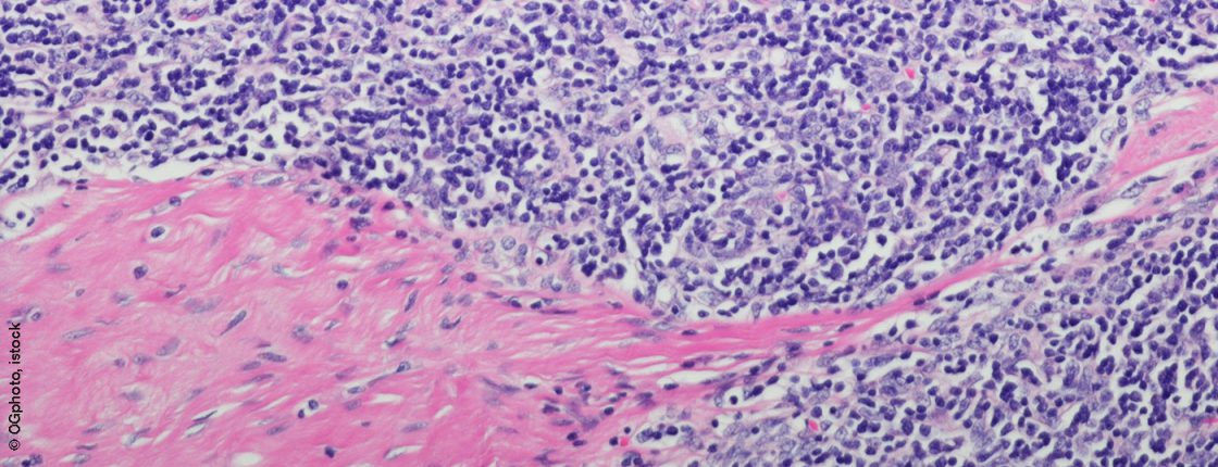 Reconnaître les tumeurs du thymus et les traiter selon l'état de l'art ...