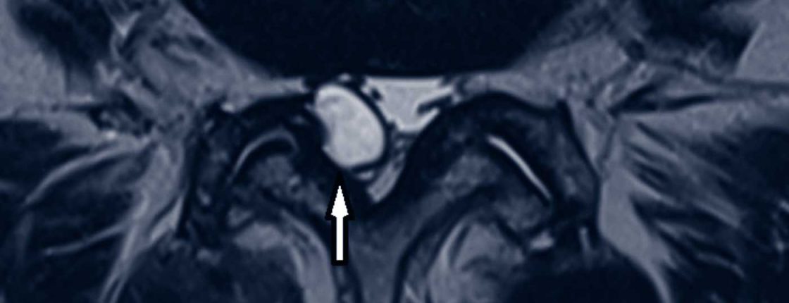Vertebral changes: intraspinal synovial cyst - Medizinonline