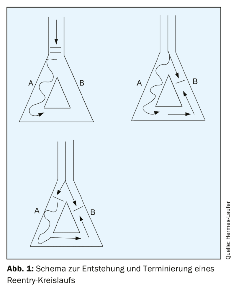 Narrow complex tachycardia - differential diagnosis and management ...