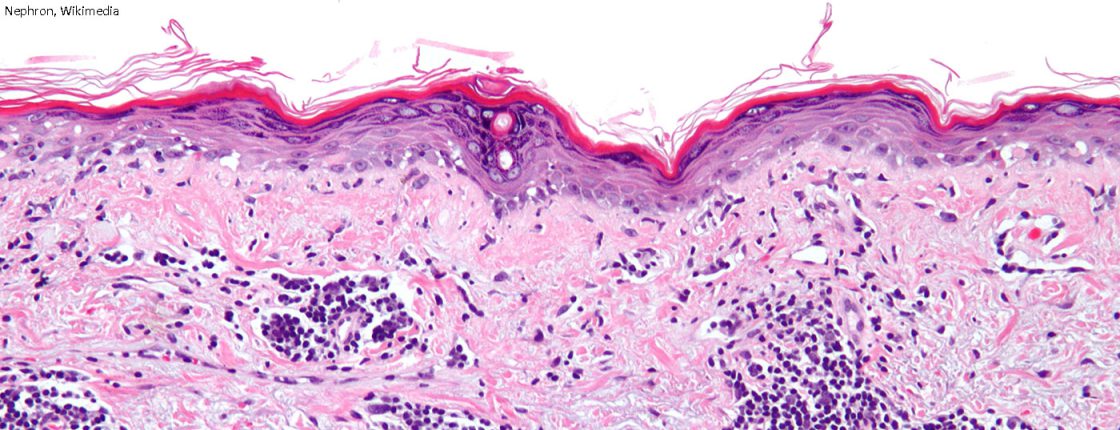 New possibilities for SLE therapy - Medizinonline
