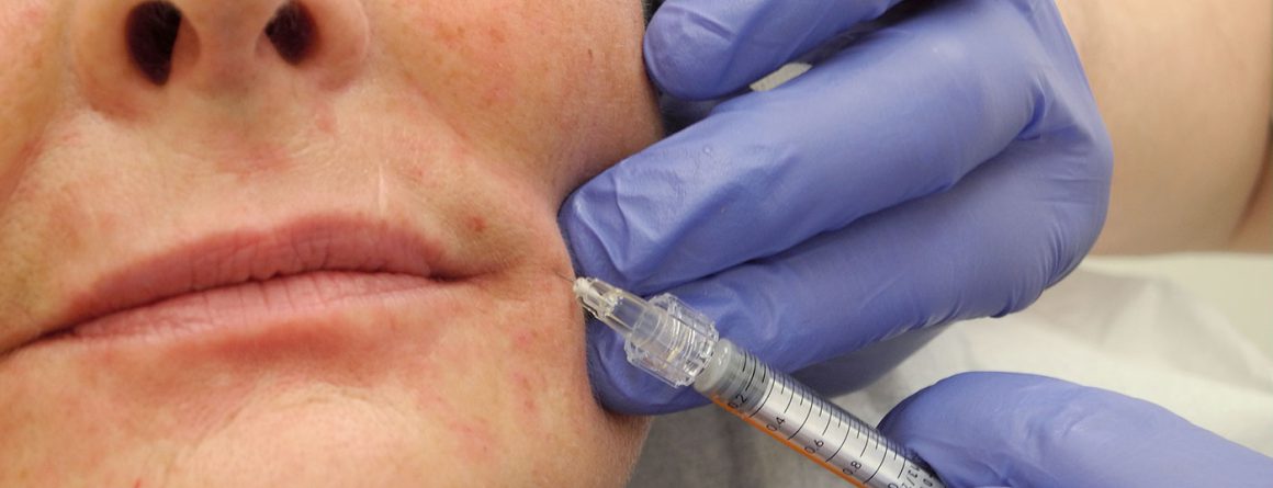 What is critical for successful filler treatments? - Medizinonline