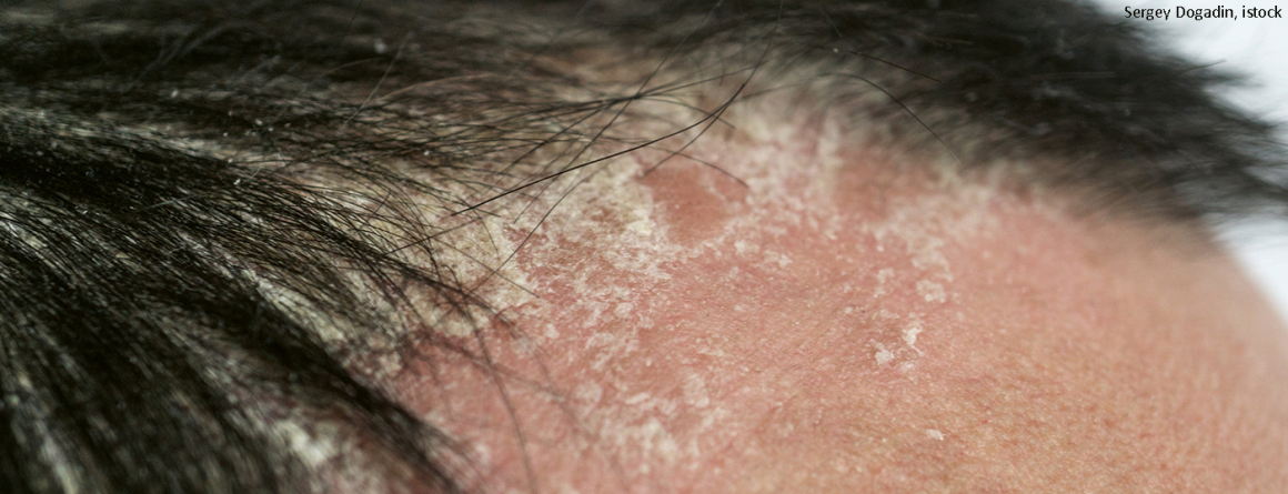 Effective reduction of itching in the context of scalp psoriasis ...