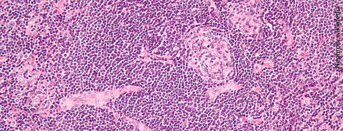 When is lymph node swelling serious? - Medizinonline