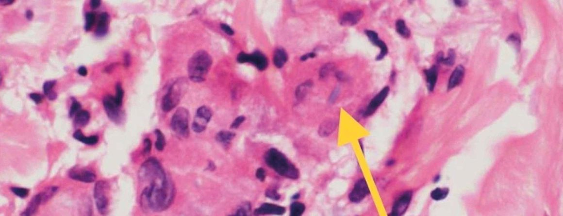 Anular elastolytic giant cell granuloma - Medizinonline