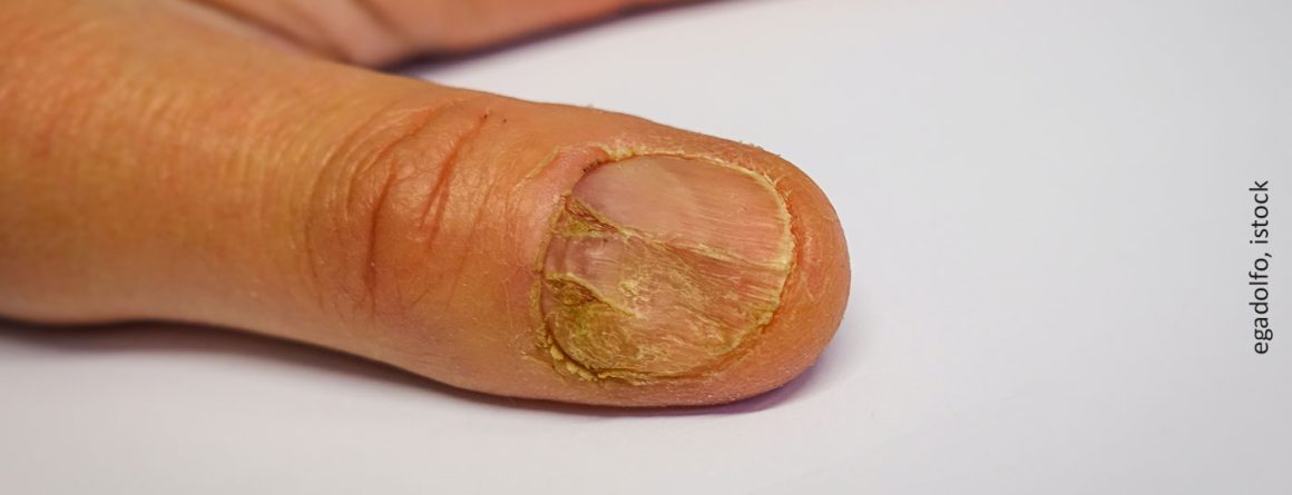 Therapie der Nagelpsoriasis – ein Update - Medizinonline