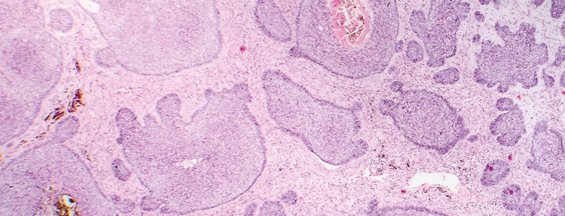 Deep learning algorithm to accelerate dermatopathology assessment ...
