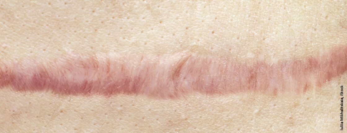 Nicht-invasive Narbenbehandlung mit modernster Lasertechnologie ...