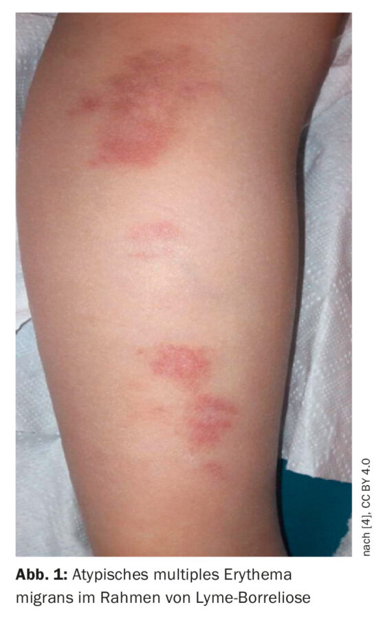 Cutaneous manifestations of Lyme disease: case series. - Medizinonline