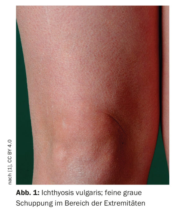 Broad spectrum of genetic cornification disorders - Medizinonline