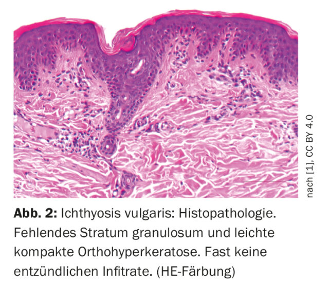 Broad spectrum of genetic cornification disorders - Medizinonline