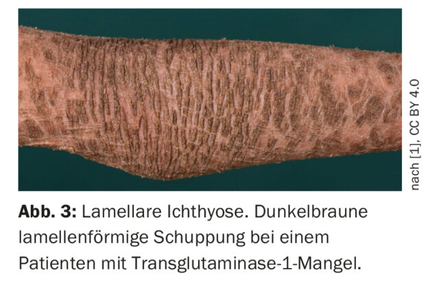 Broad spectrum of genetic cornification disorders - Medizinonline