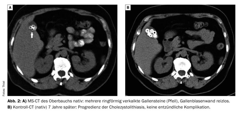 Abdominal pain - gallstones - Medizinonline