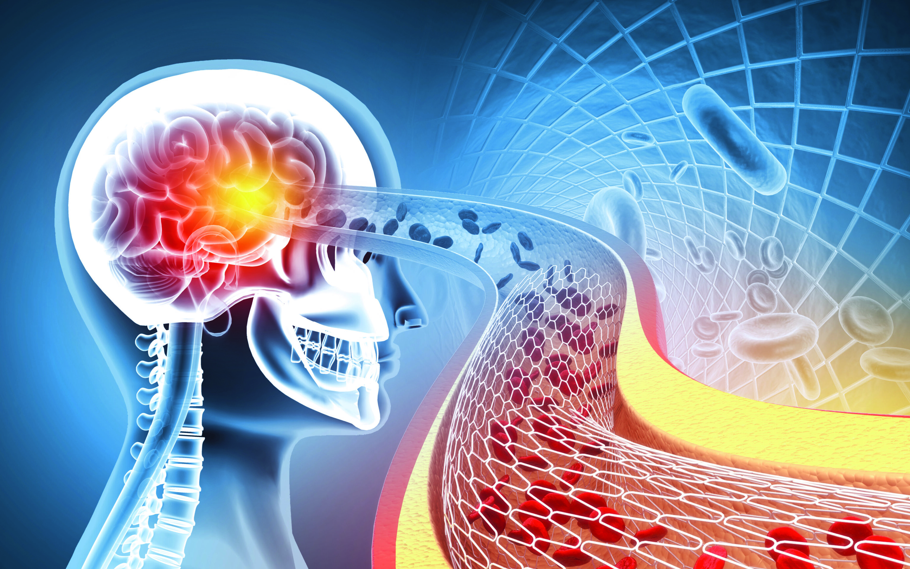 Nutzen einer Thrombektomie nach ischämischem Hirninfarkt - Medizinonline