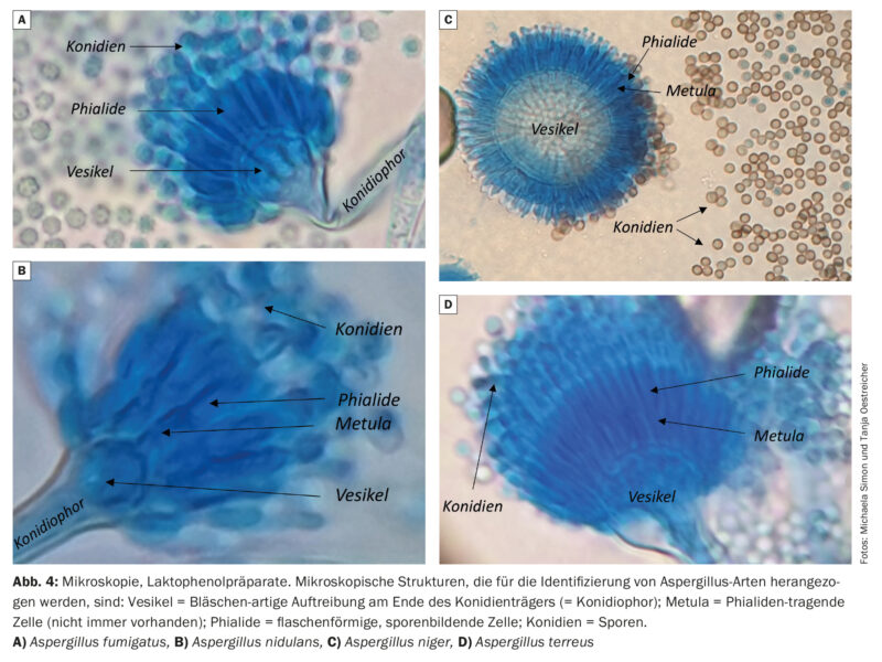 Correctly diagnose and treat IPA - Medizinonline