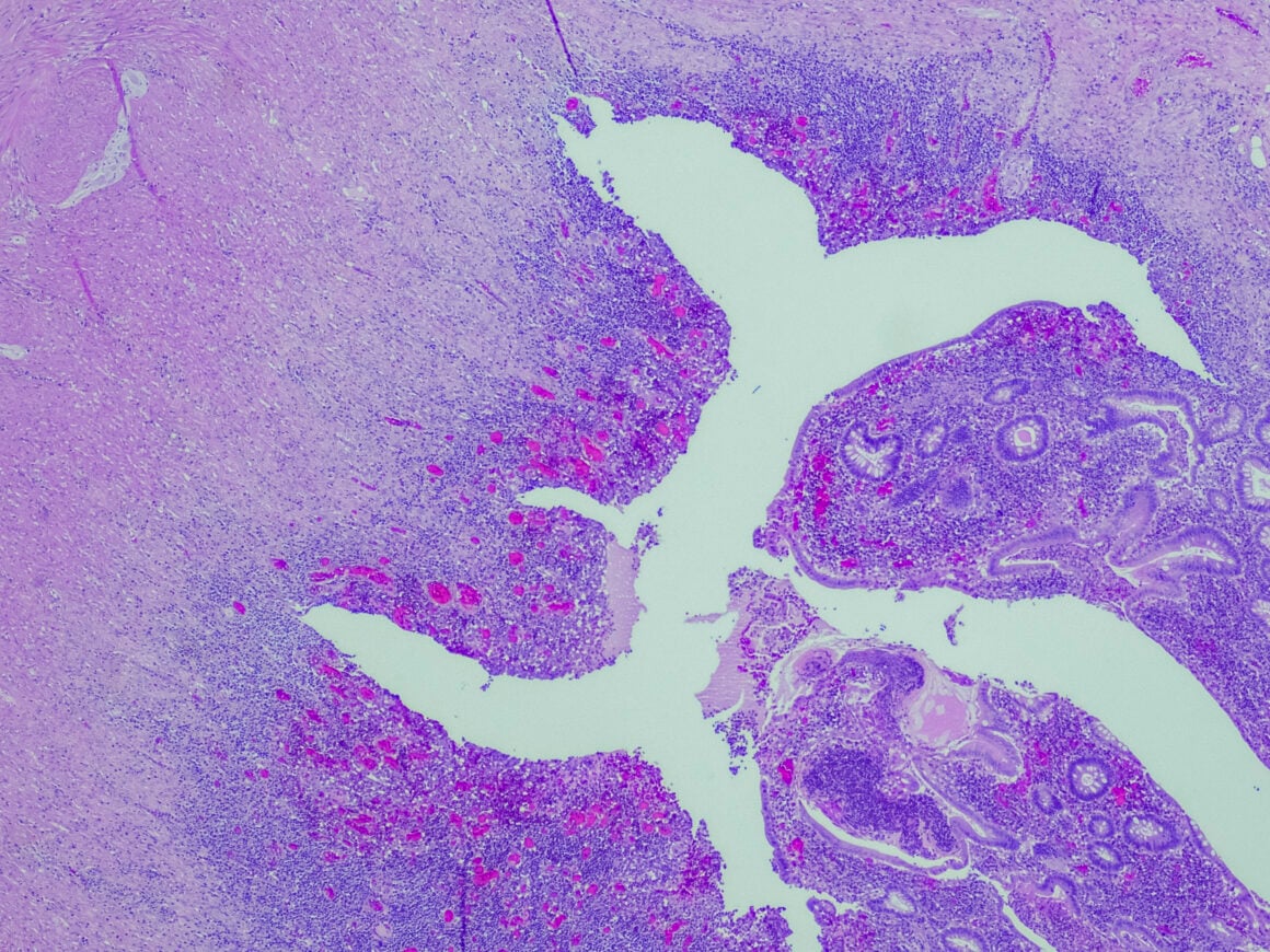 Wound chronicity and tumorigenesis - relevance of T cell-mediated ...