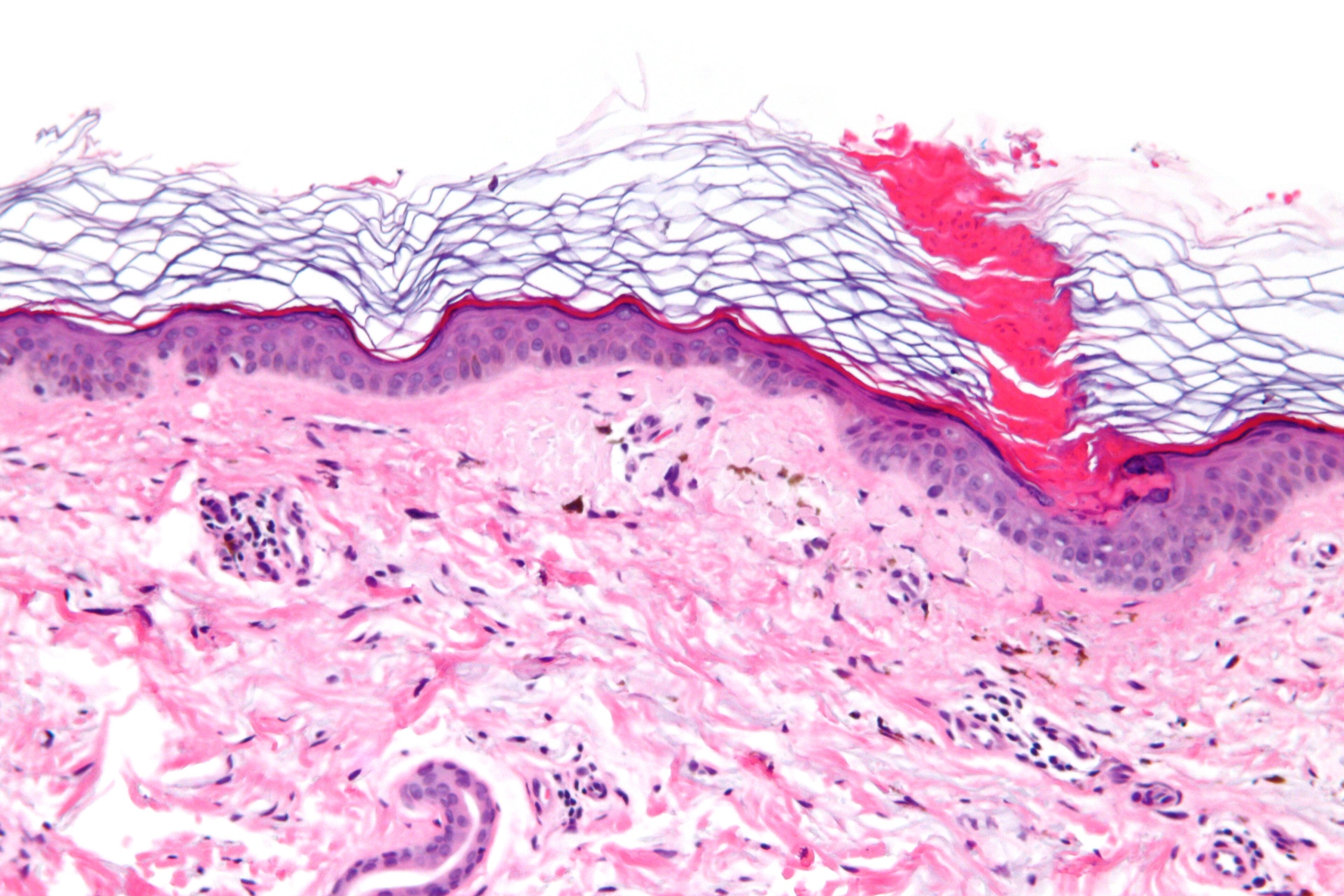 Porokératoses - trouble chronique de la kératinisation de l'épiderme ...