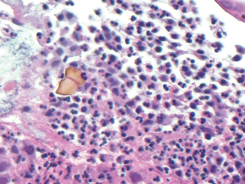 Précurseur du cancer de la peau clair - quels sont les facteurs de ...