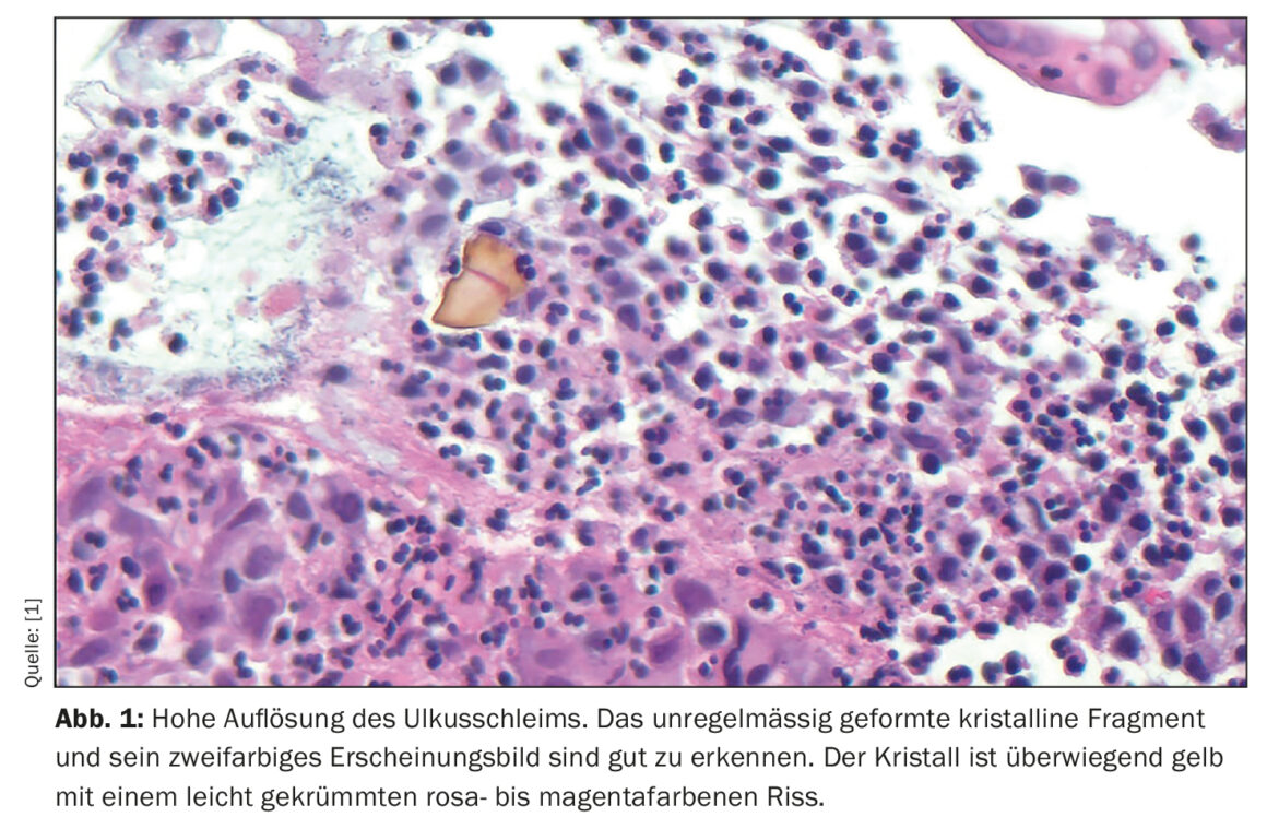 Colitis due to sevelamer crystals - Medizinonline