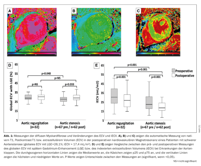 Evaluación postoperatoria de la fibrosis miocárdica en la valvulopatía ...