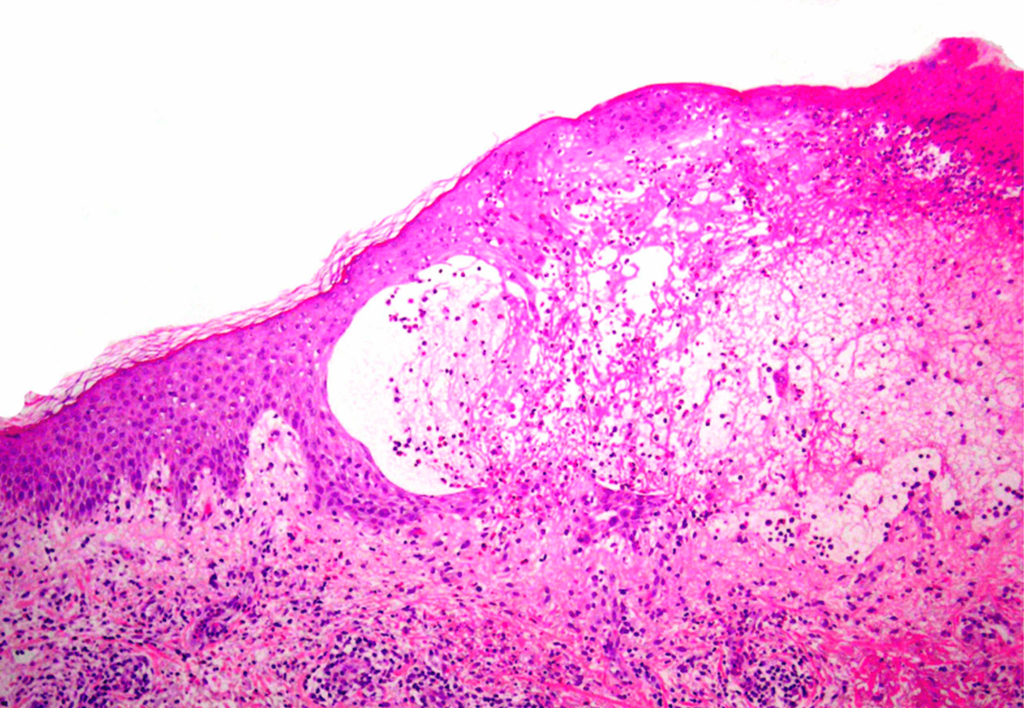 Bullous Pemphigoid Histology Pemphigus Vulgaris: Diagnosis, Treatment,