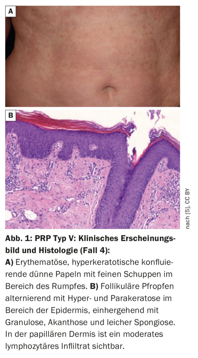 Supposedly therapy-resistant PRP responded to biologic treatment ...