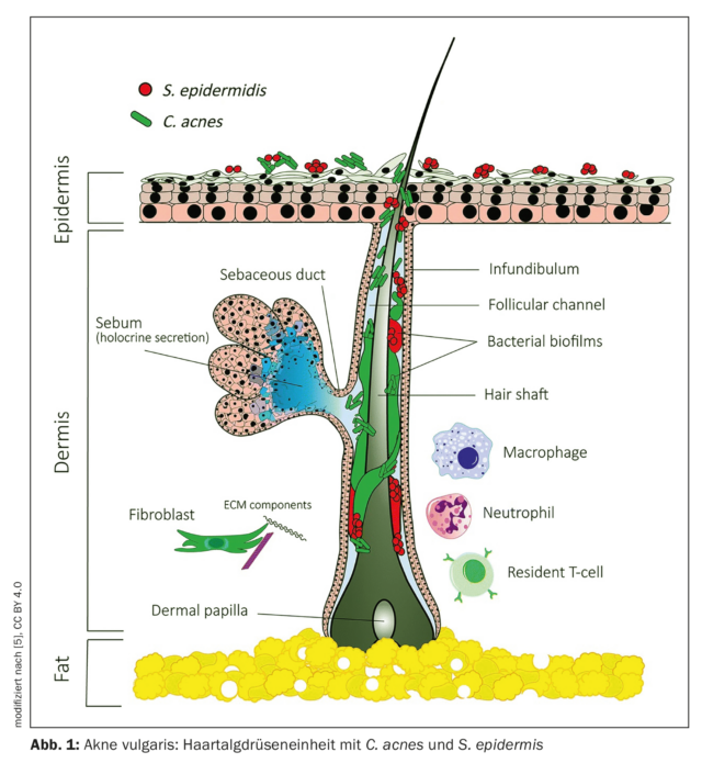 Multifactorial etiopathogenesis - an update - Medizinonline