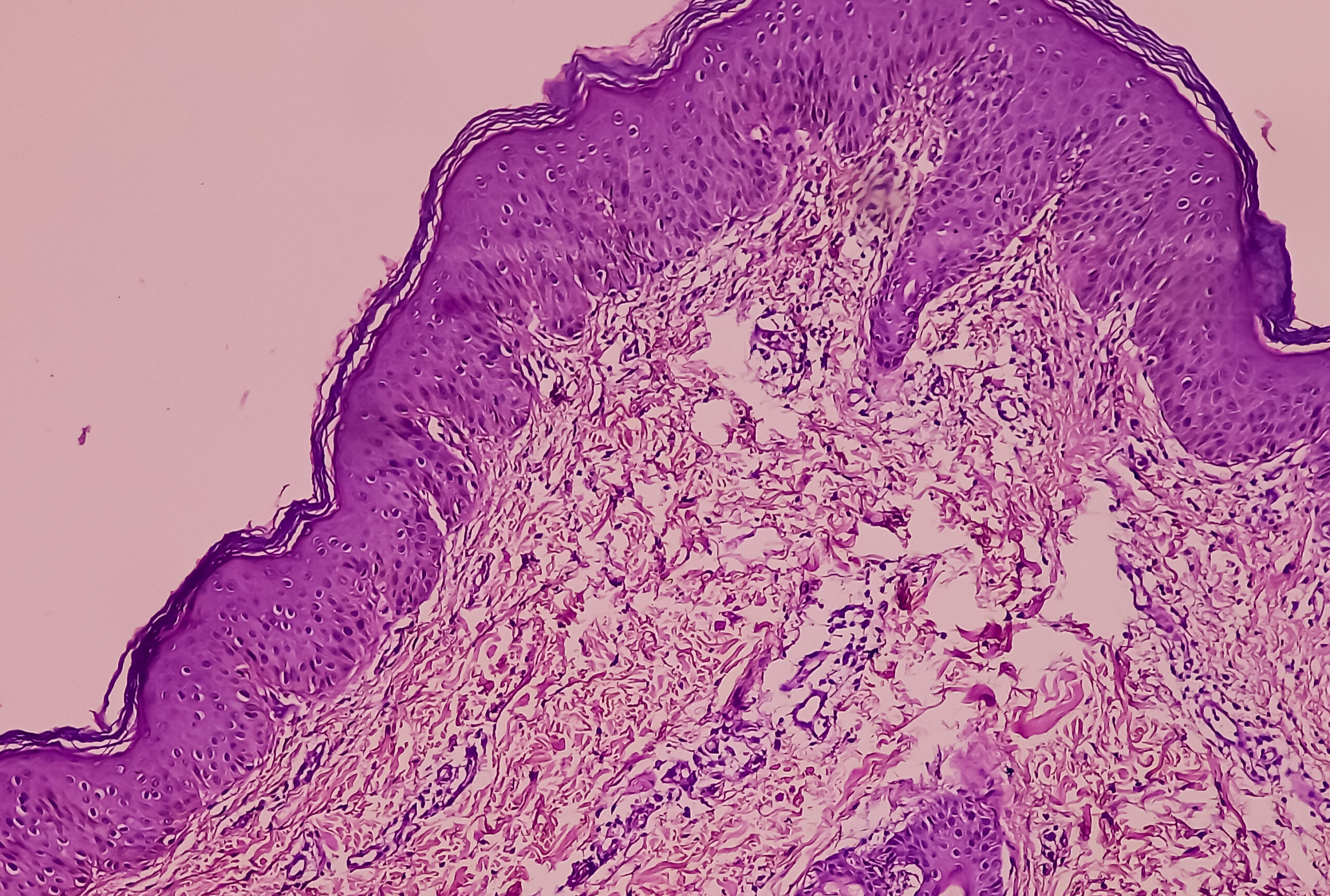 Forma especial de la enfermedad de Mucha-Habermann en la infancia ...