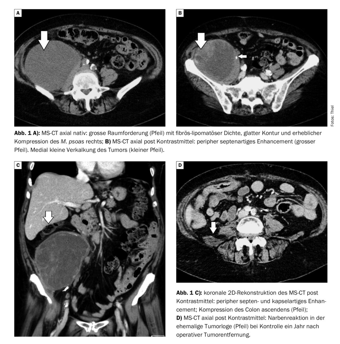 Abdominal pain - retroperitoneal liposarcoma - Medizinonline