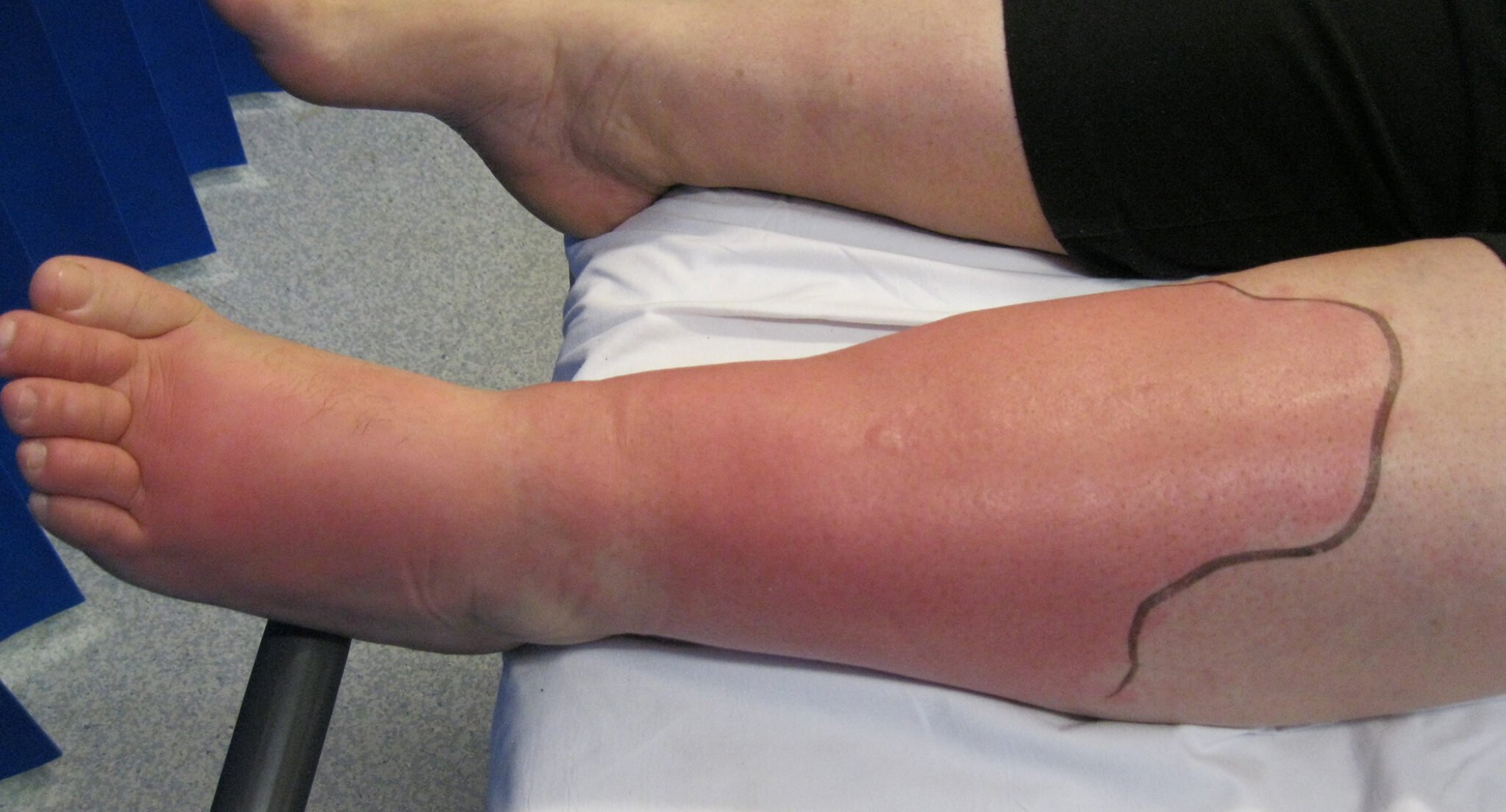 Erysipelas and cellulitis: important "hot topics" - Medizinonline