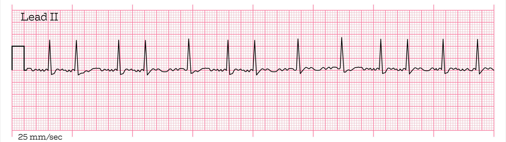 HAS-BLED score as a reference point for risk stratification - Medizinonline